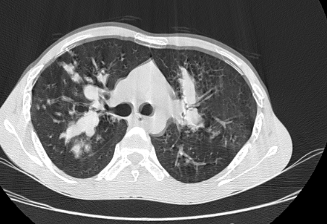 Allergic Bronchopulmonary Aspergillosis-HRCT - Sumer's Radiology Blog