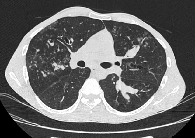 Allergic Bronchopulmonary Aspergillosis-HRCT - Sumer's Radiology Blog