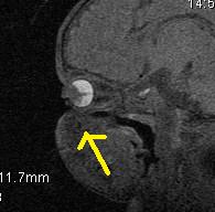 Persistent Hyperplastic Primary Vitreous-MRI - Sumer's Radiology Blog