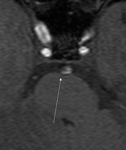 Basilar Artery Dissection-MRI - Sumer's Radiology Blog