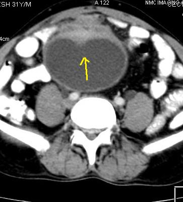 Urachal Carcinoma-CT - Sumer's Radiology Blog
