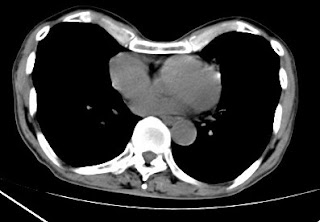 Funnel chest (pectus excavatum)-CT - Sumer's Radiology Blog