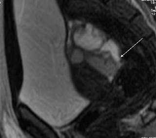 Holoprosencephaly: Hematometra with hematosalpinx-MRI