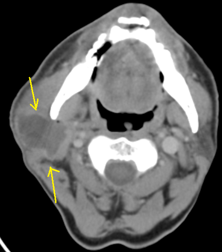 Parotid Abscess - Sumer's Radiology Blog