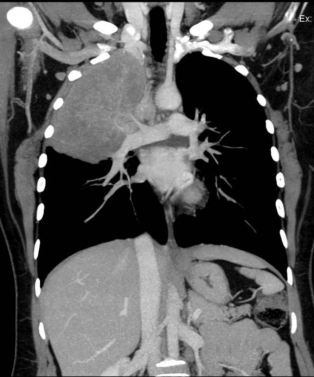 Adenosquamous Carcinoma Lung-CT - Sumer's Radiology Blog