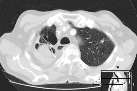 Air Mensicus Sign in Hydatid Disease - Sumer's Radiology Blog