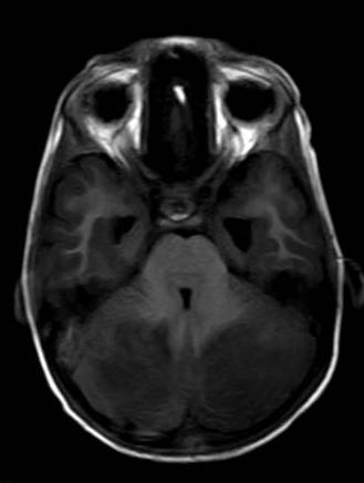 Acute cerebellitis-MRI - Sumer's Radiology Blog