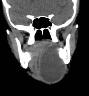 Ranula-CT images - Sumer's Radiology Blog