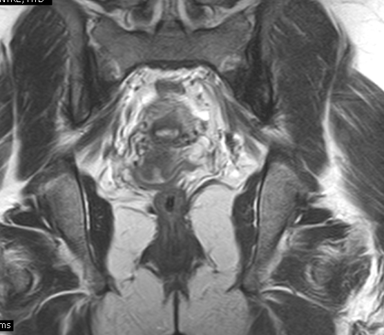 Osteitis Condensans ilii-MRI - Sumer's Radiology Blog