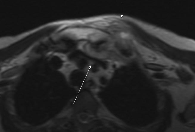 Sternoclavicular Joint Tuberculosis-MRI - Sumer's Radiology Blog