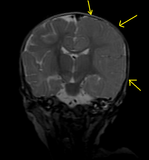 Possible Rassmussen's Encephalitis-MRI - Sumer's Radiology Blog