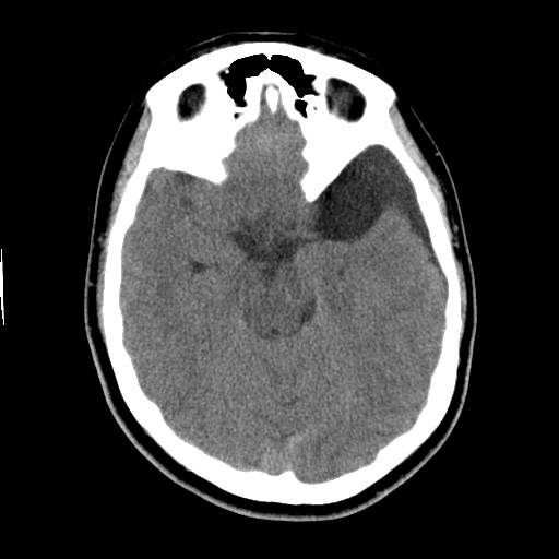 Post Traumatic Rupture of Arachnoid Cyst-CT - Sumer's Radiology Blog