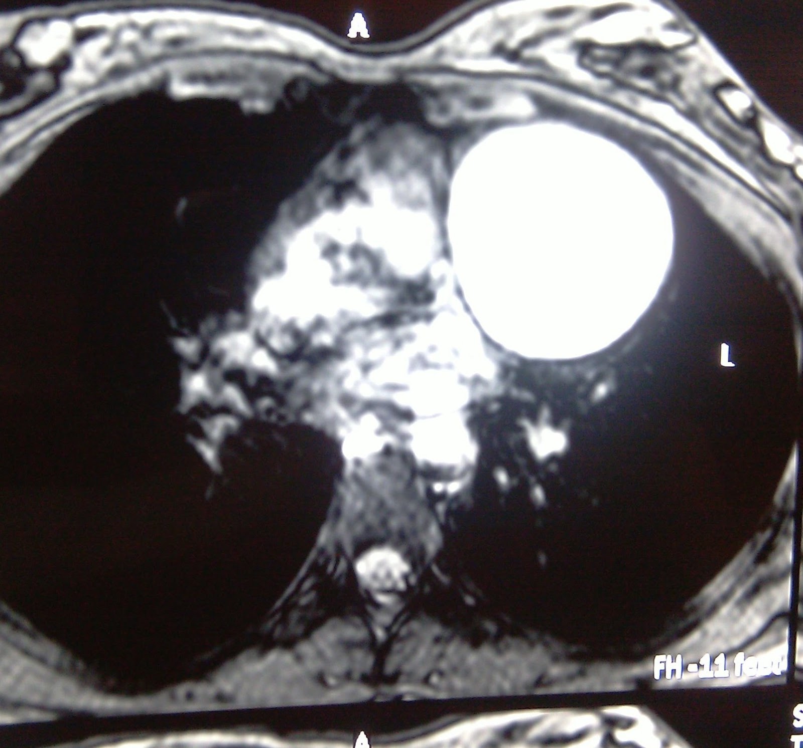 Bronchogenic Cyst Mri Sumers Radiology Blog