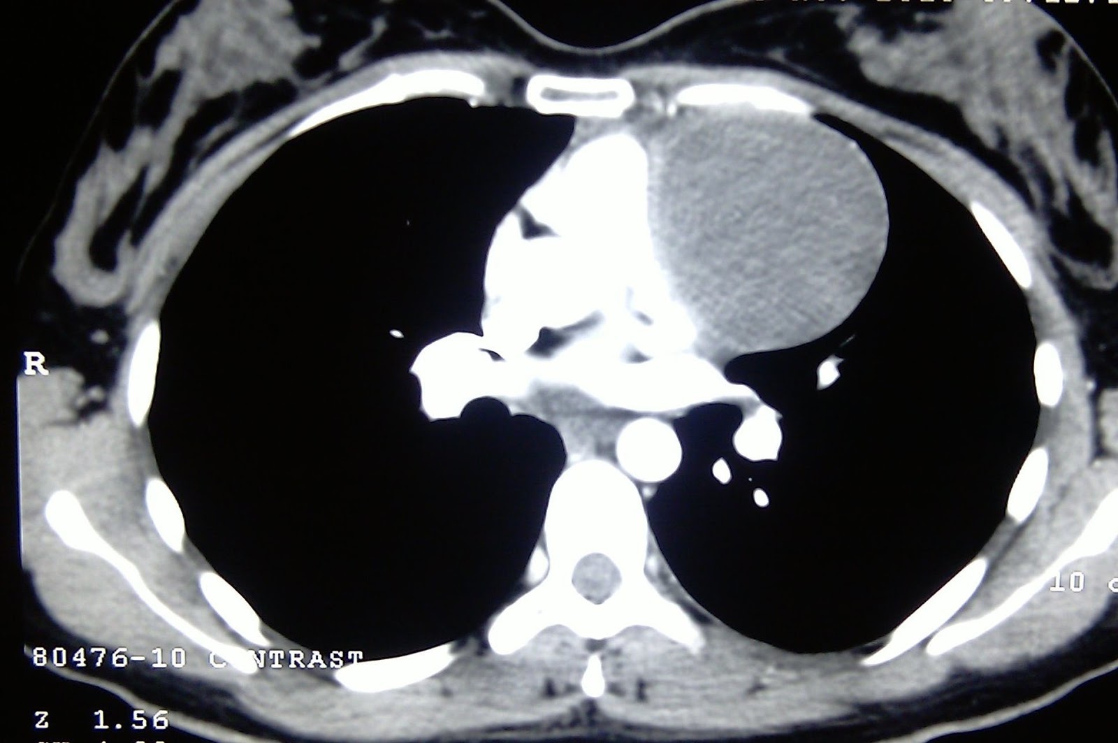 Bronchogenic Cyst Mri Sumers Radiology Blog