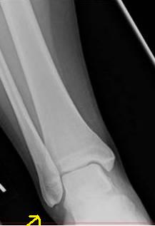 Os Subfibularis - Sumer's Radiology Blog