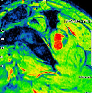 Infraspinatus muscle cyst-MRI - Sumer's Radiology Blog