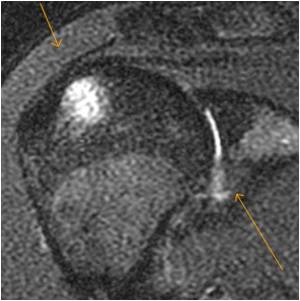 Shoulder Dislocation-MRI - Sumer's Radiology Blog