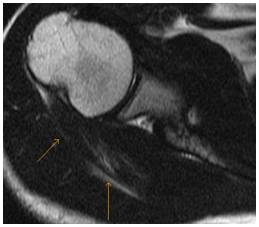 Shoulder Dislocation-MRI - Sumer's Radiology Blog