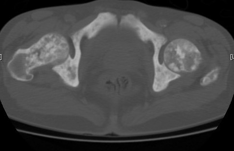 Carcinoma Prostate-Osteoblastic Metastases - Sumer's Radiology Blog