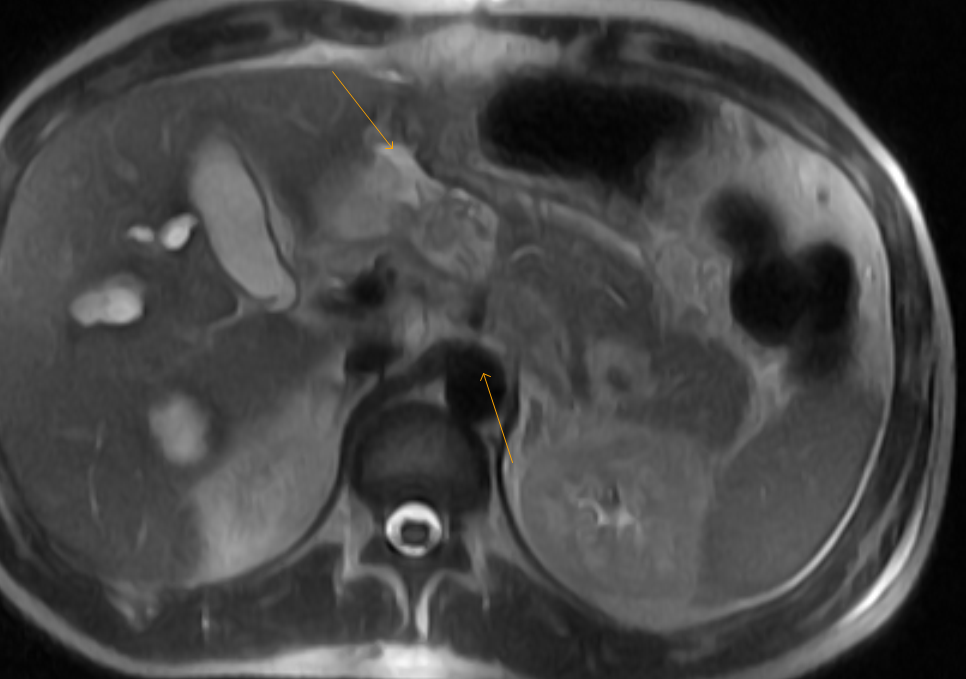 Pancreatic Transection-MRI - Sumer's Radiology Blog