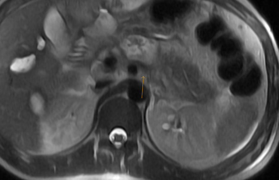 Pancreatic Transection-MRI - Sumer's Radiology Blog
