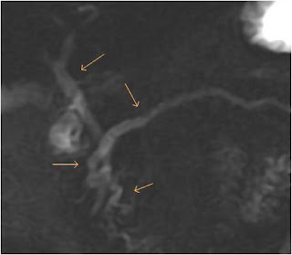 Pancreatic Divisum-MRCP - Sumer's Radiology Blog