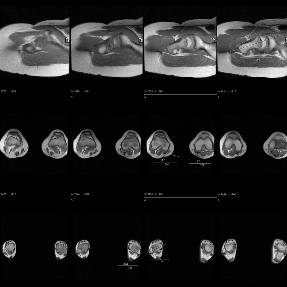 Utah Pediatric Radiology: Femoral/tibial torsion studies