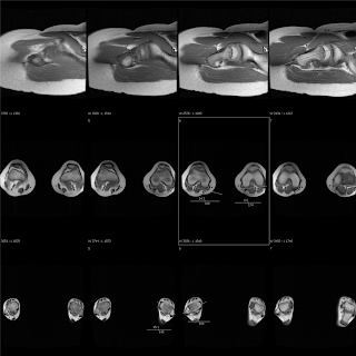 Utah Pediatric Radiology: Femoral/tibial torsion studies
