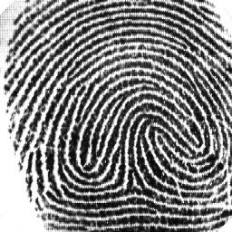 Modern & Multidimensional Iridology: Accidental Whorl