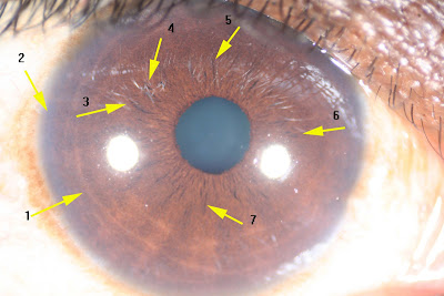 Modern & Multidimensional Iridology: Iridology Analysis-21