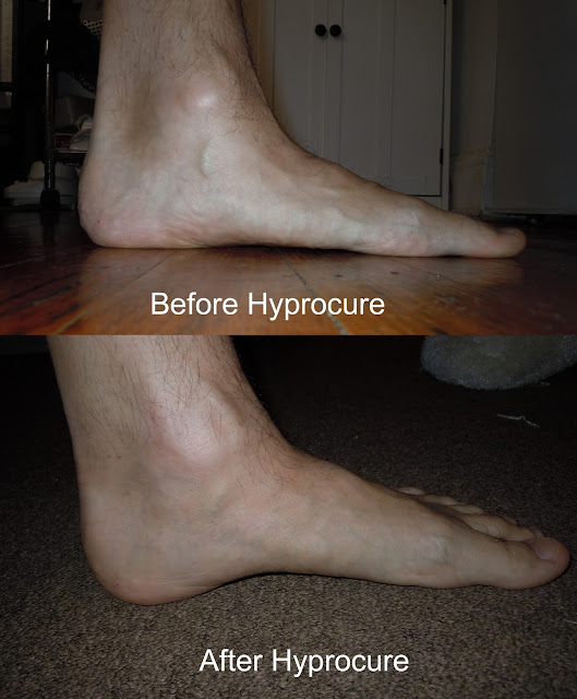Hyprocure Implant - Flat Feet Corrective Surgery