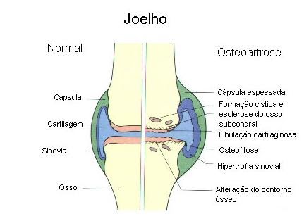 4 CORREDORES: Resultado da Ressonância Magnética – Joelho Esquerdo - A ...
