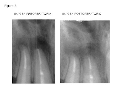 Dentista en Roquetas: Apicectomía
