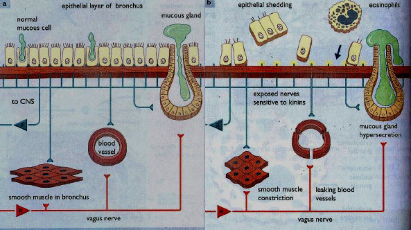 Asma Bronkiale (Model Makalah) ~ TEKNOBIOMEDIK