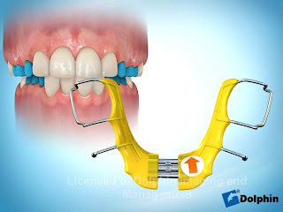 doctors videos backup: Dentistry: Mandibular Expander (Removable)