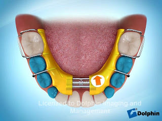 doctors videos backup: Dentistry: Mandibular Expander (Removable)