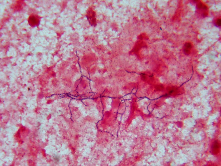 Fun With Microbiology (What's Buggin' You?): Nocardia species