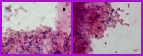 Fun With Microbiology (What's Buggin' You?): Bacterial Vaginosis