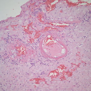 Perinatal Pathology: Acute Atherosis