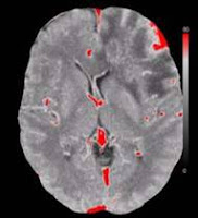 Aplikasi Klinik Multi Slice CT Scan: Pemeriksaan Neuro Perfusion