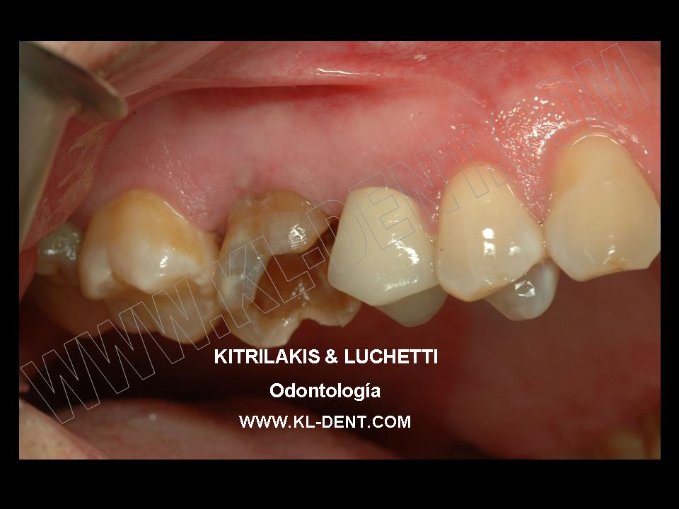 Kitrilakis & Luchetti - Dentistry: Dental Implant in Upper Molar: Case 2