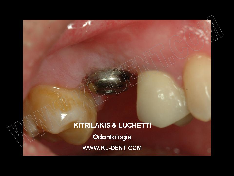 Kitrilakis & Luchetti - Dentistry: Dental Implant in Upper Molar: Case 2
