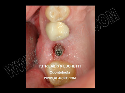 Kitrilakis & Luchetti - Dentistry: Dental Implant in Upper Molar: Case 2