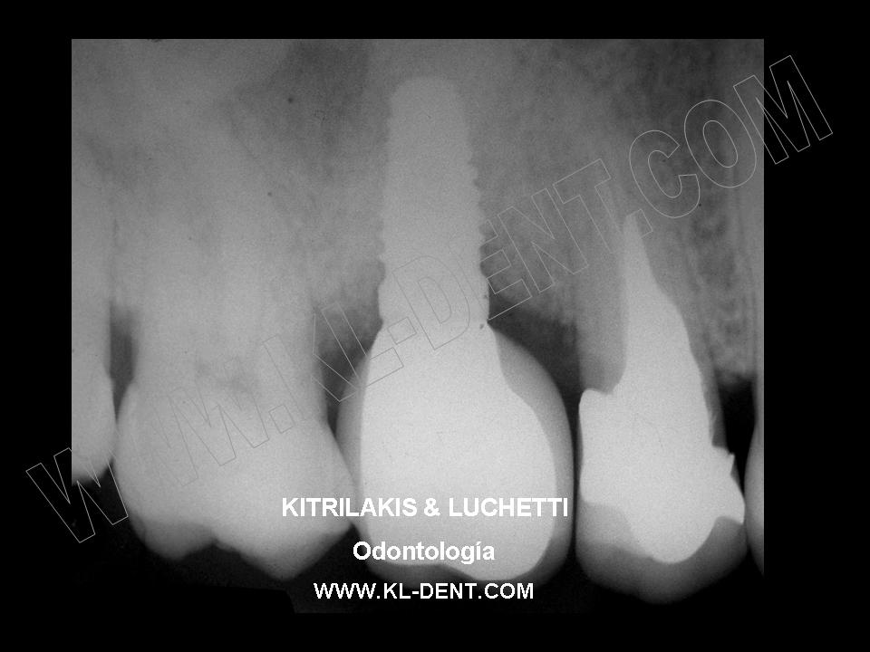 Kitrilakis & Luchetti - Dentistry: Dental Implant in Upper Molar: Case 2