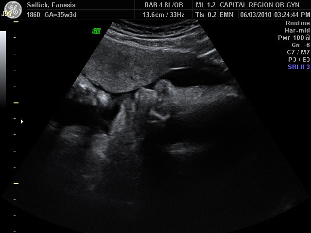 Vanscoy's Little Monster: 35-36 Weeks - Last Ultrasound