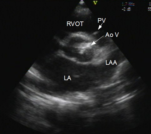 Cardiology Blog: Echocardiography Imaging Windows - The Parasternal Window
