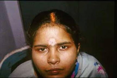 LIFEWATCH: CHEMICAL LEUCODERMA - AN INDIAN EXPERIENCE