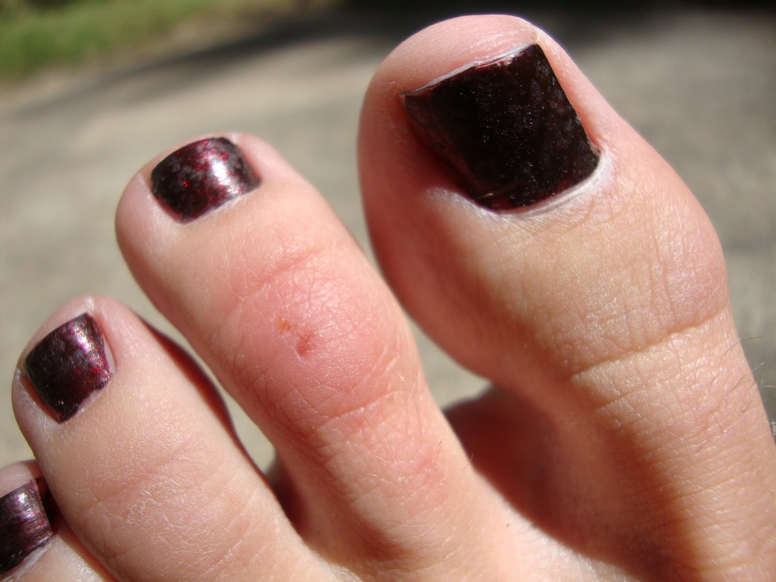 being Rachy: hunted by mosquitos