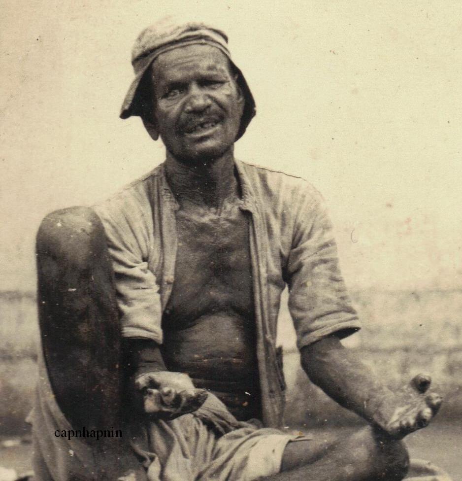 Leper Man Begging - India 1930's - Old Indian Photos