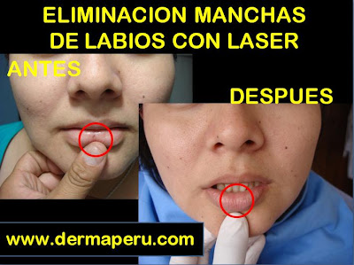 Tratamiento de manchas de los labios con laser por Dermatologo en Lima ...